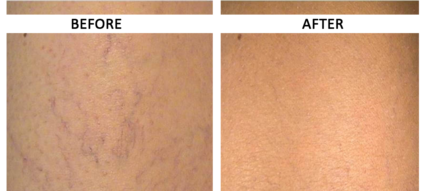 Vascular Lesion Reduction – LEMON + LEIGH
