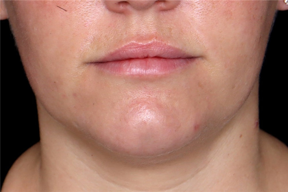 Dermal Fillers – Lemon + Leigh